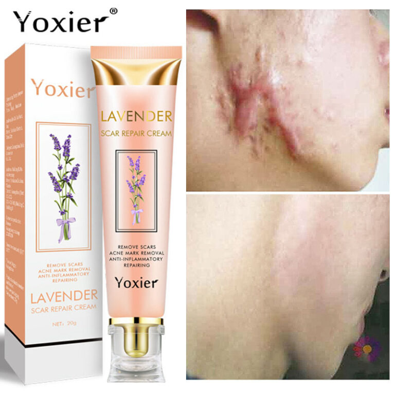 Yoxier Lavender Scar Repair... - KM Goods